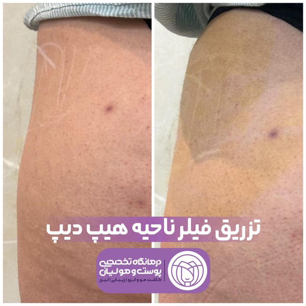 Fixing the hollow of the thigh or hip dip - Lian clinic